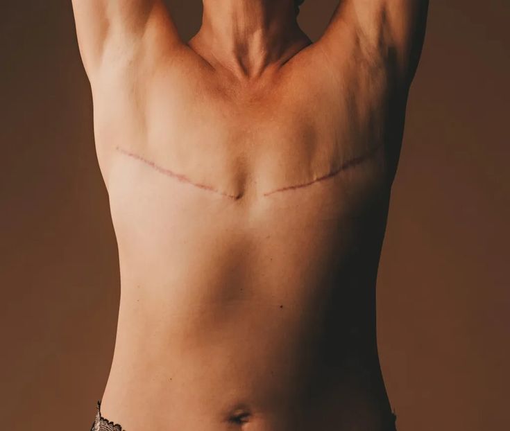 Empower Your Body with Aesthetic Flat Closure After Mastectomy